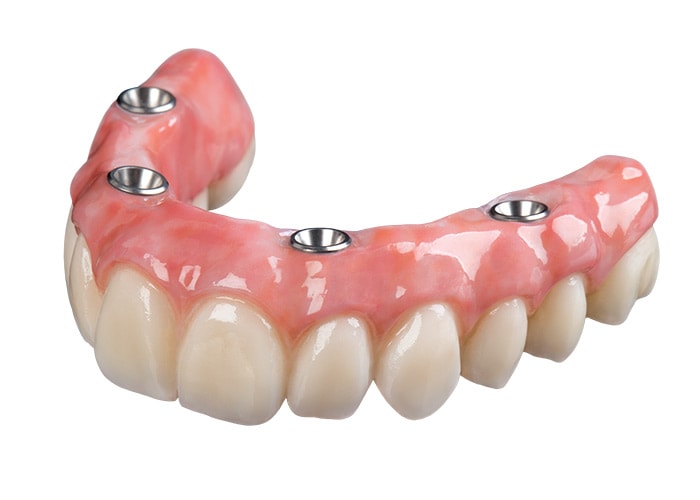 Implant Services - Elite Dental Lab