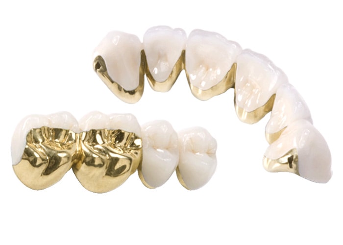 High Noble - Elite Dental Lab