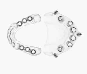 Surgical Guides - Elite Dental Lab